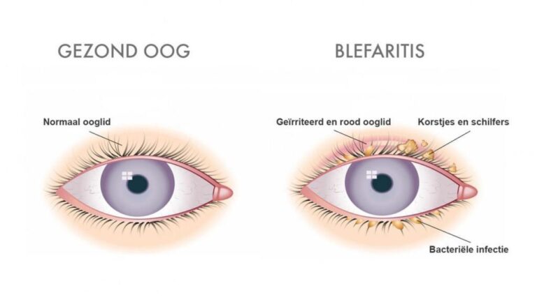Blefaritis – De ziekte van Parkinson & de ogen